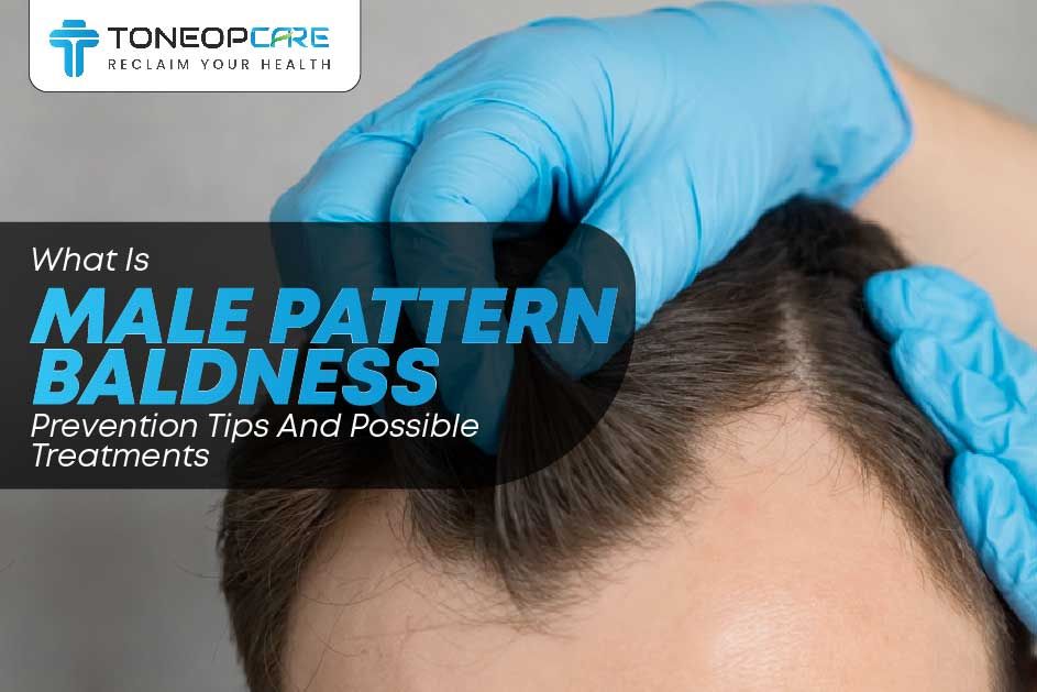 What Is Male Pattern Baldness? Tips & Treatments | ToneOpCare